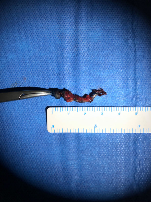Preauricular Sinus: Infected Hole in front of Your Ear